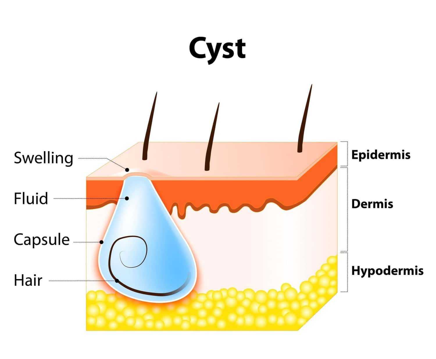 Sebaceous Cyst: Surgical Excision Techniques & More - Icy Health