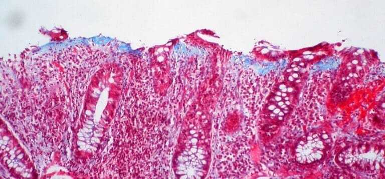 How To Repair Gut After Antibiotics: 6 Easy Steps - Icy Health