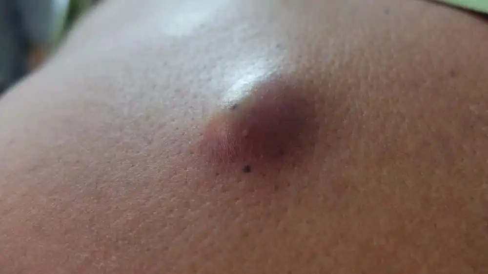 Sebaceous Cyst: Definition and 3 Commonly Used Surgical Excision ...