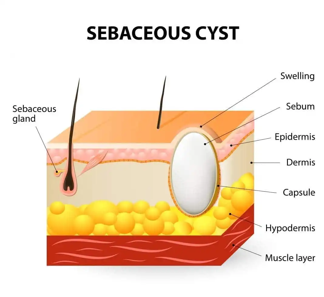 Sebaceous Cyst: Definition and 3 Commonly Used Surgical Excision ...